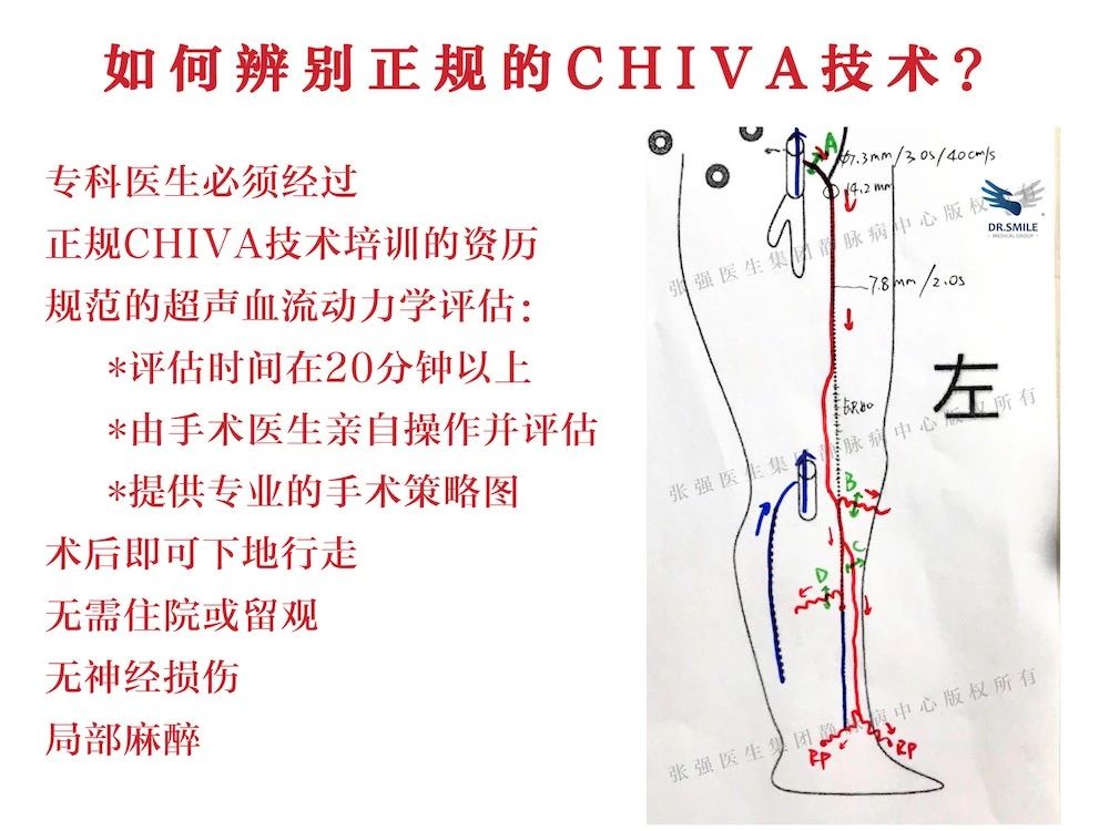 CHIVA技术，轻松告别下肢静脉曲张 - 成都鹏瑞利国际医疗健康中心